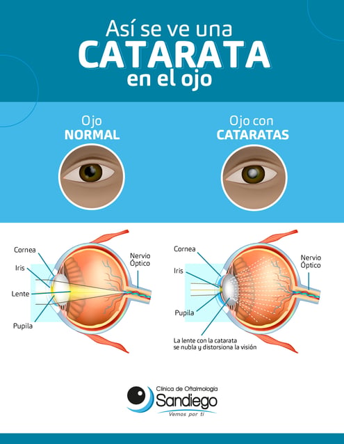 Síntomas de cataratas: ¿Cuándo deberías considerar la cirugía?
